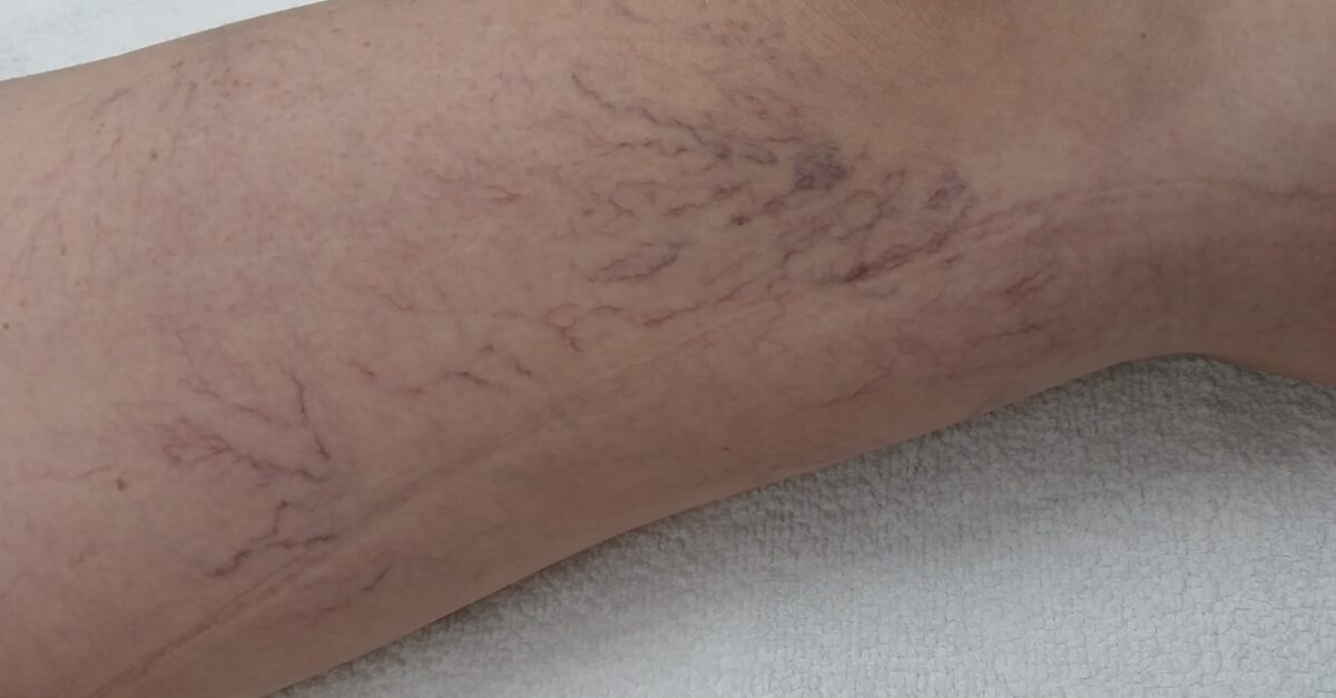 Spider Vein Treatment for Face & Legs » Laser Hair & Skin Clinic